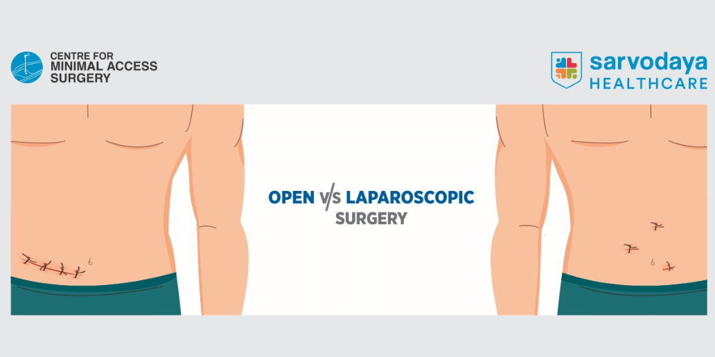 Laparotomy Vs Laparoscopy Full Article: Minilaparotomy Vs Laparoscopic